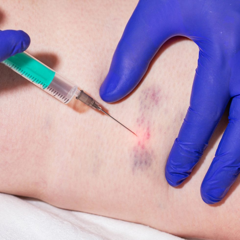 Escleroterapia con Microespuma - CLíNICA VASCULAR JARAMILLO